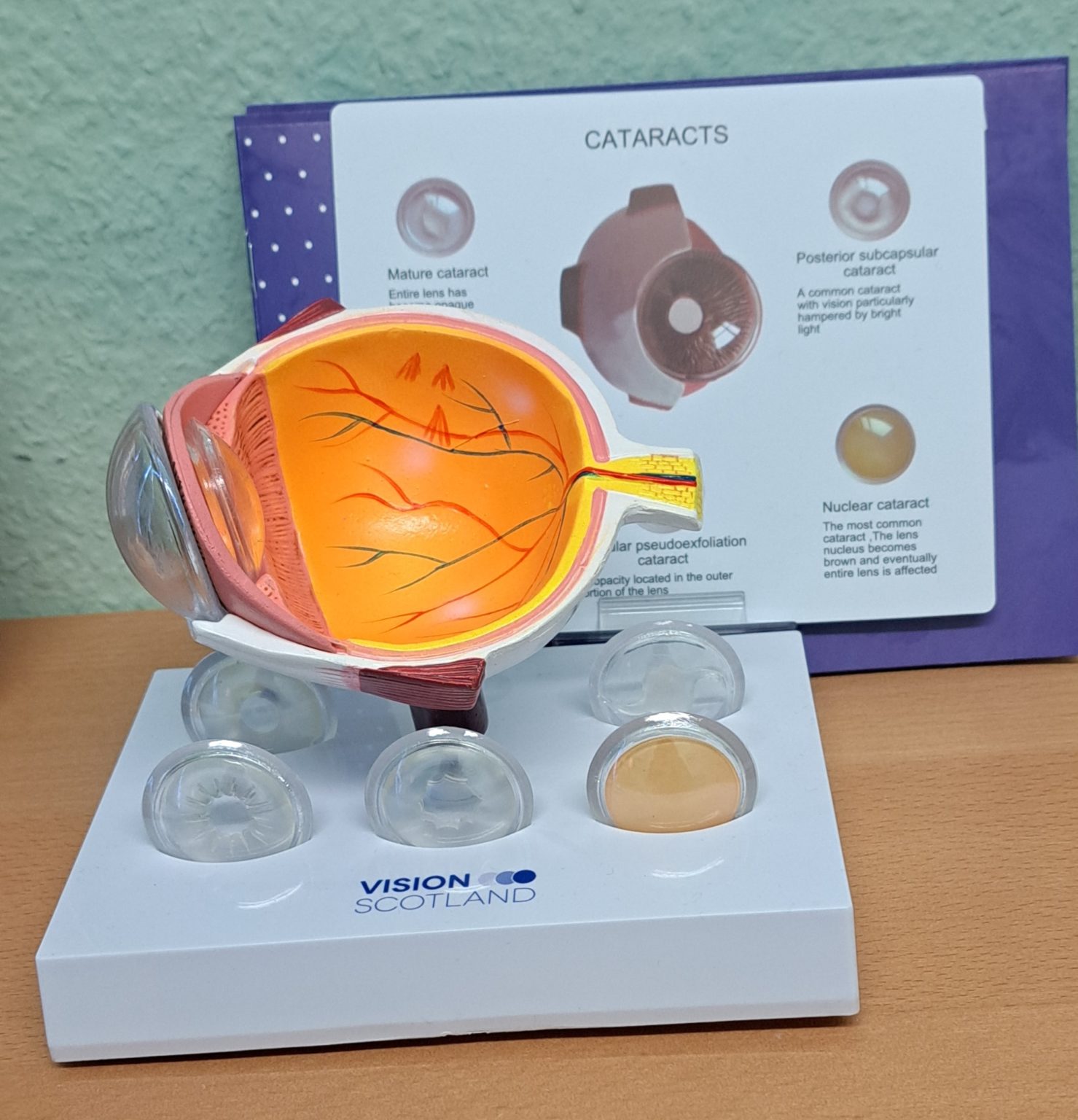 Cataracts - Lindsay & Johnson Opticians